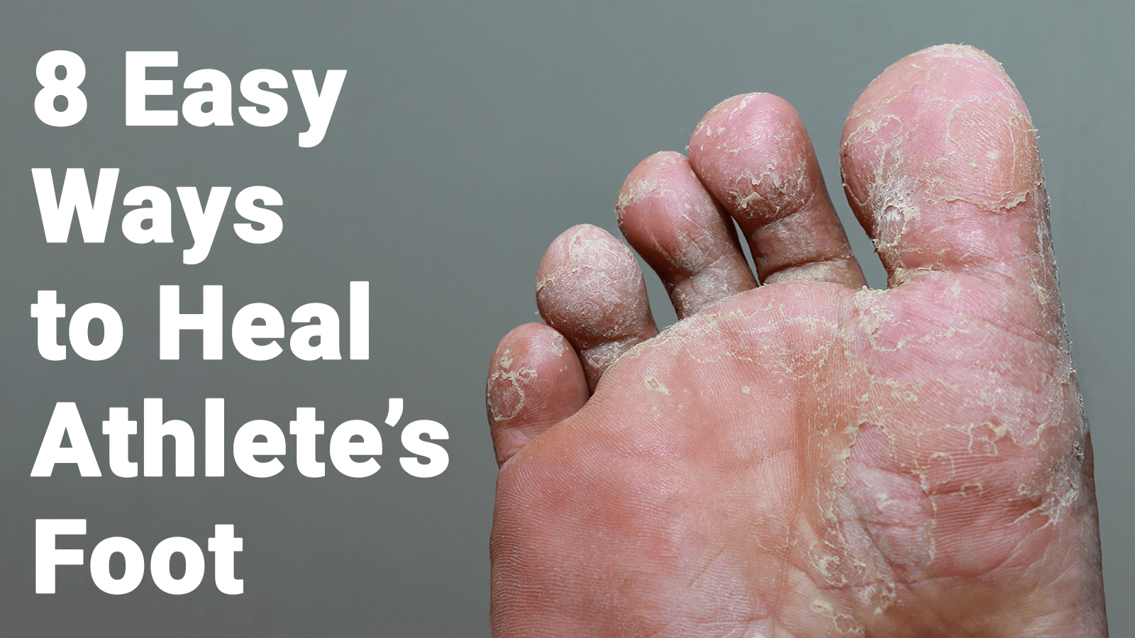 8 Easy Ways To Heal Athlete s Foot 8 Easy Ways To Heal Athlete s Foot