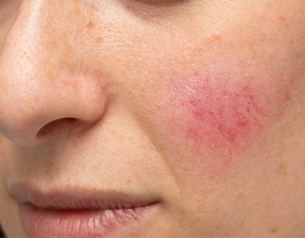 10 Rashes That Could Reveal a Dermatologic Disease